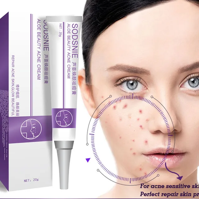 Aloe Acne Treatment Cream Pimple Acne Mark Blackhead Removal Moisturizing Oil Control Face Gel ...