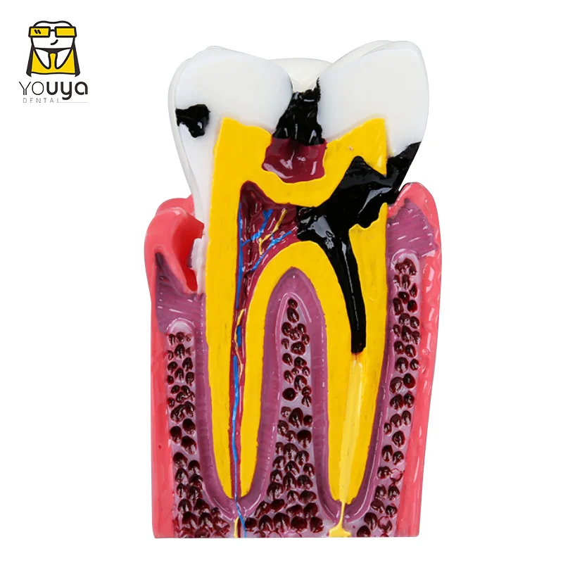 Pathological Tooth Model For Dental Students Dental Caries Model ...