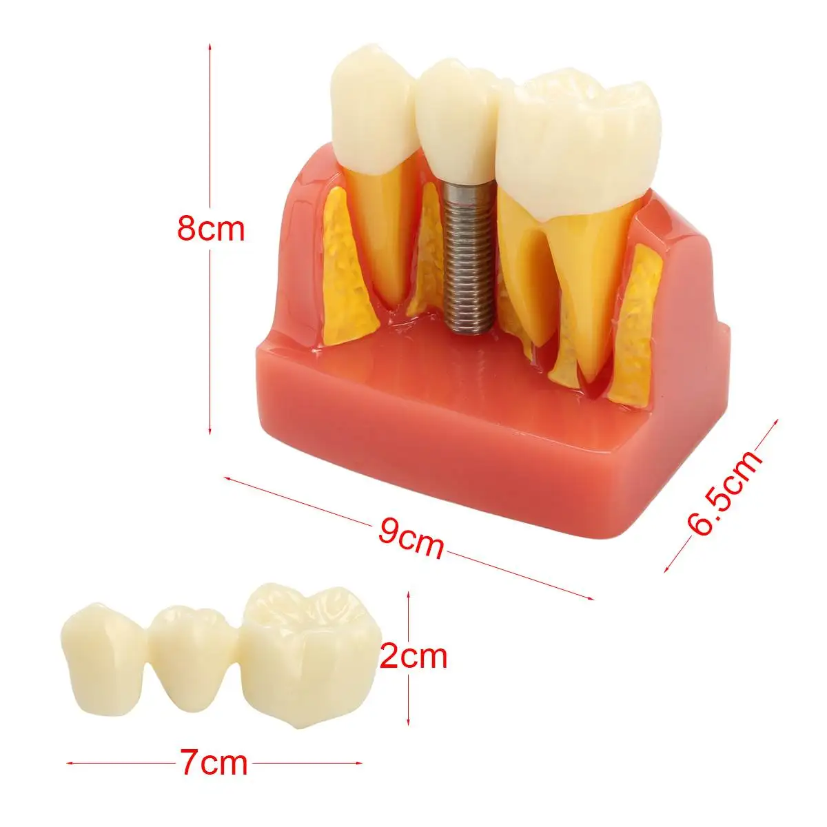 Dental Teach Implant Analysis Crown Bridge Removable Model Dental ...