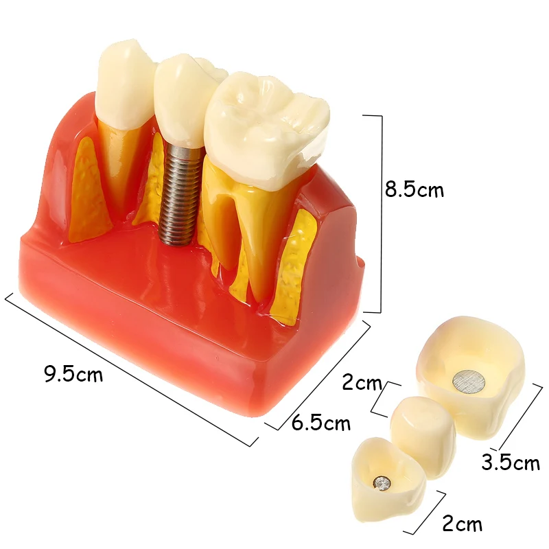 4 Times Dental Implant Disease Teeth Medical Science Model Oral ...