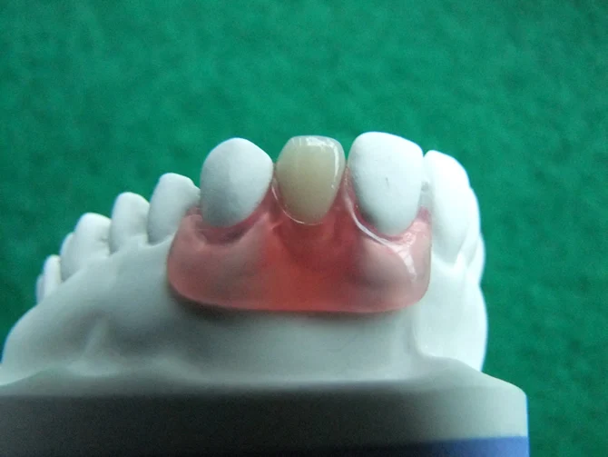 SET UP TOOTH FOR VALPLAST ( 1 3 TOOTH)|tooth clock|tooth guardset span ...