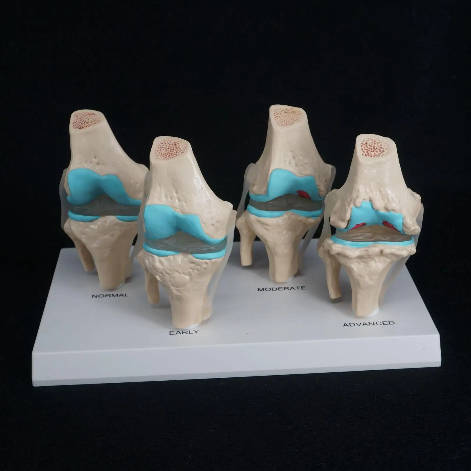Human Knee Joint Model 4 Stage Knee Joint Disease Model Skeleton Model ...