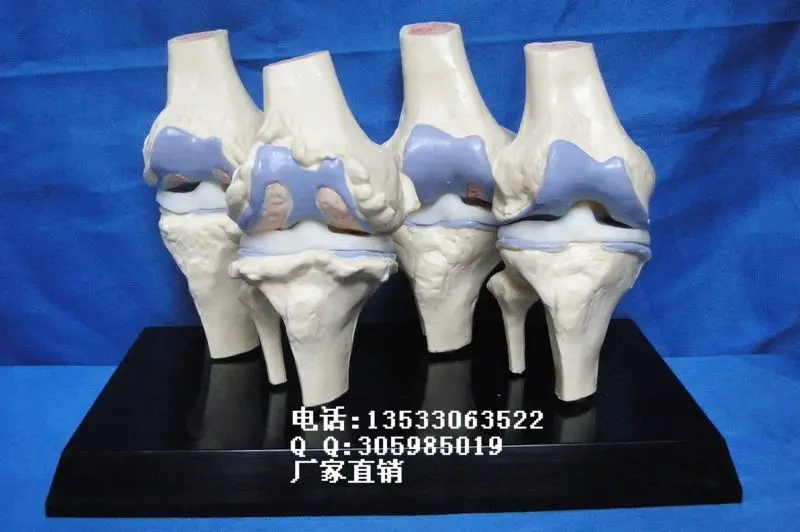 normal-knee-model-and-Pathological-changes-knee-Compare-human-skeleton ...