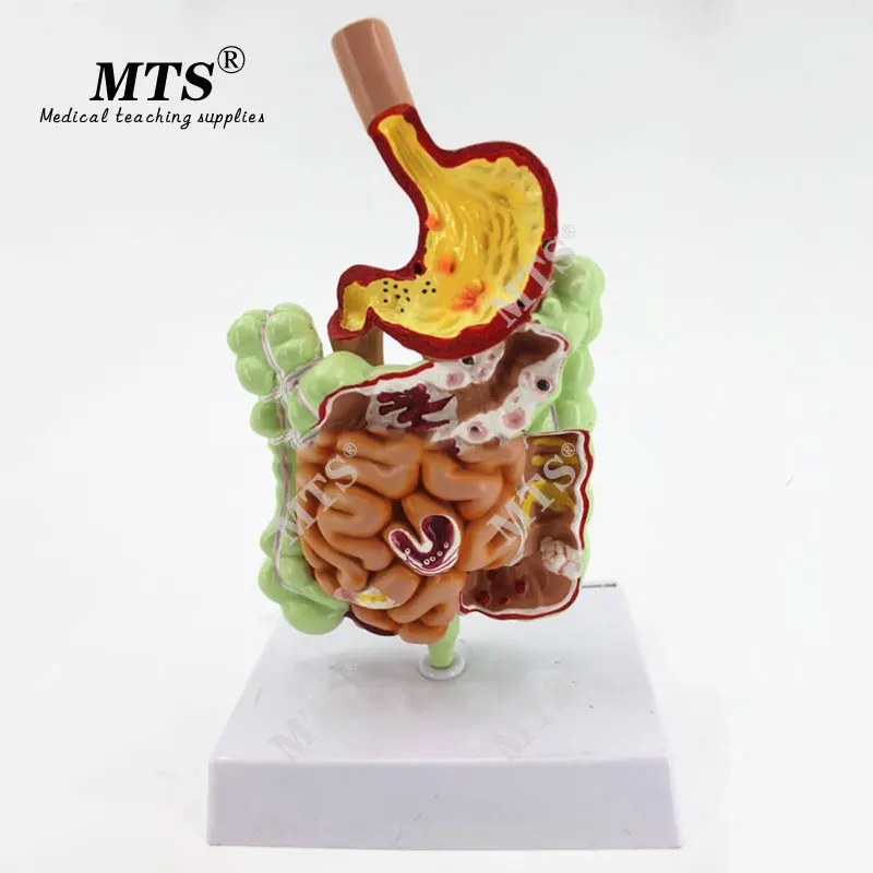 Human Gastrointestinal Pathology Anatomy Model Digestive Tract Gastric ...