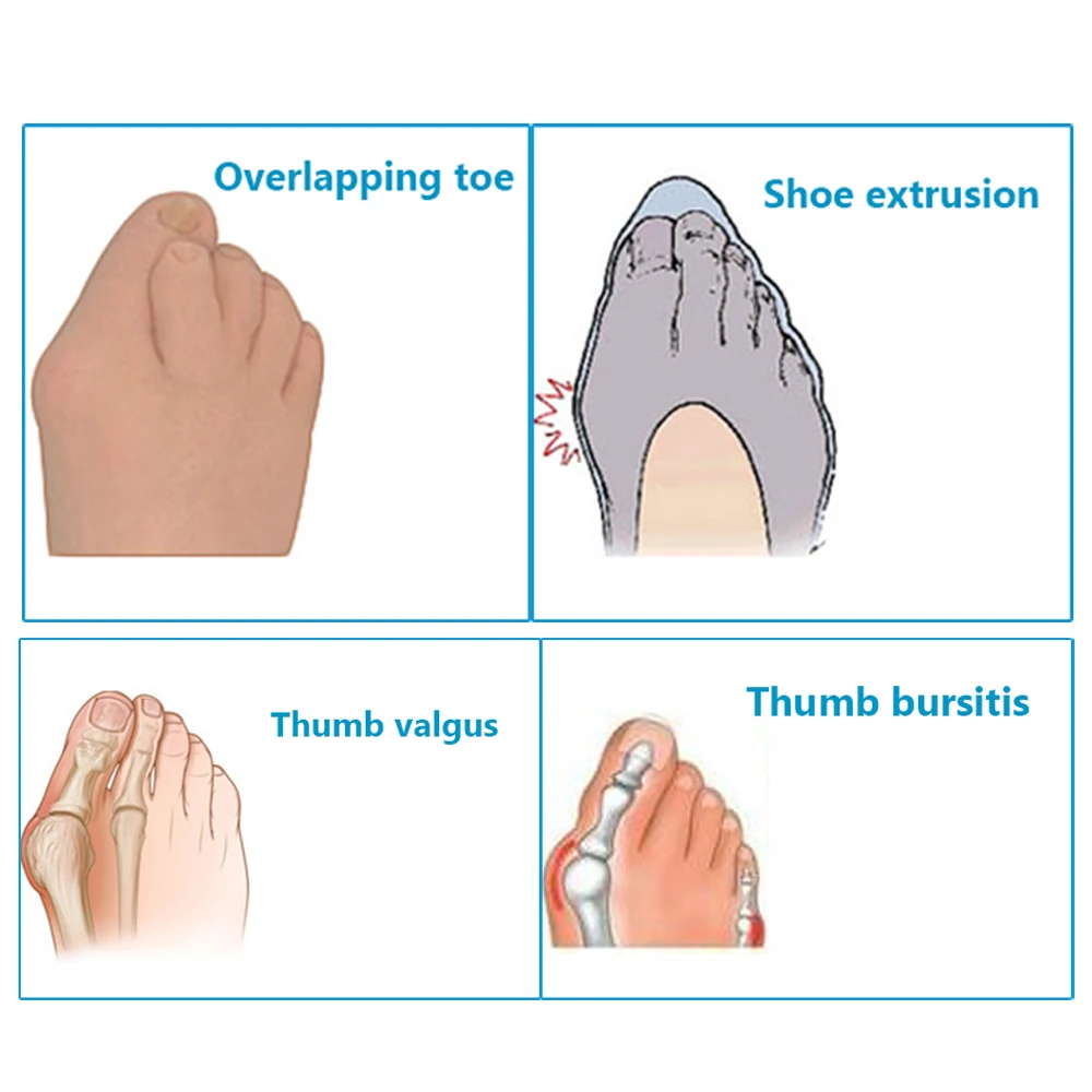 Silicone Gel Forefoot Pad Inserts For Shoes Toes Separator Fot Hallux ...