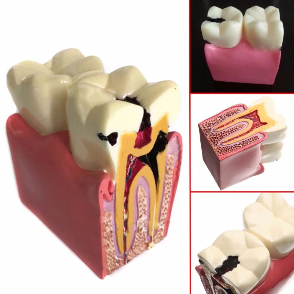 1pc Dental Anatomy Education Teeth Model 6 Times Caries Comparation ...