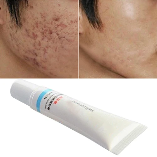 New! 15ml Remove Scar Cream Acne Spots Striae Gravidarum Removal ...