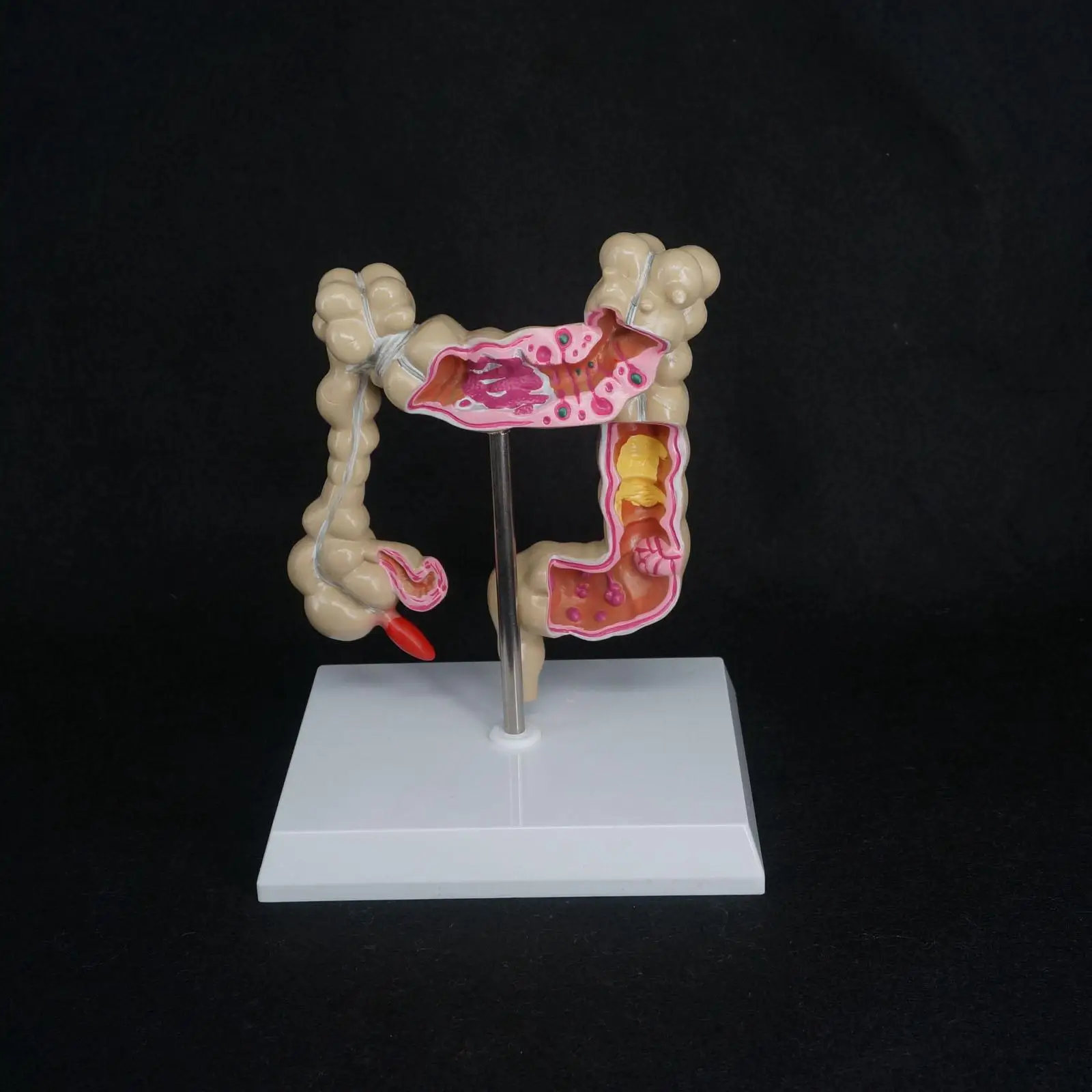 Large Intestine Model With Diseases Anatomystuffcouk