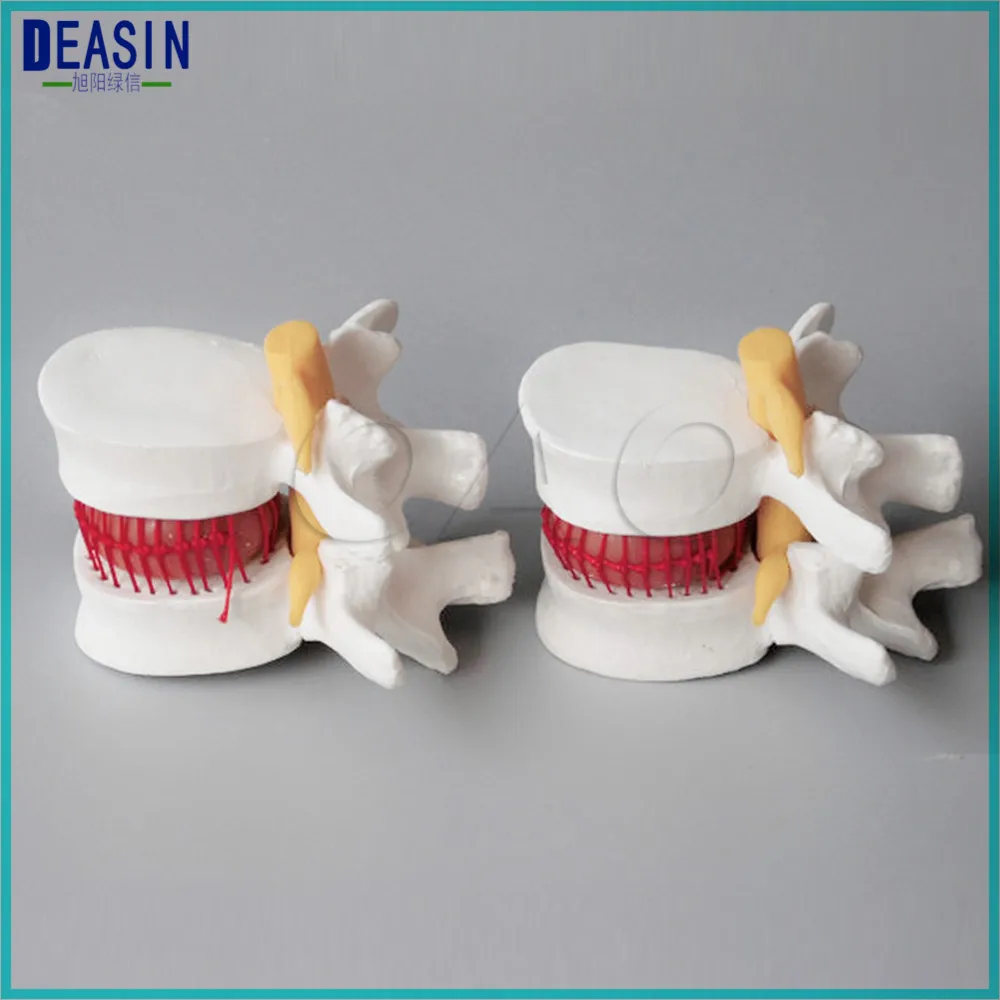 Human lumbar disc herniation model demonstration model of lumbar ...