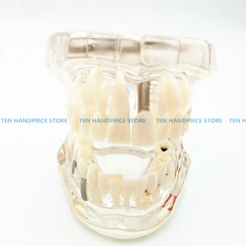 2018 good quality Dental implant Demonstration Bracket Simulation ...