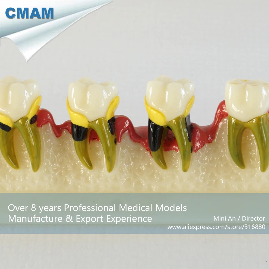 DH/13152, Root Caries Anatomy, Peridontal Diseases Developing Model ...
