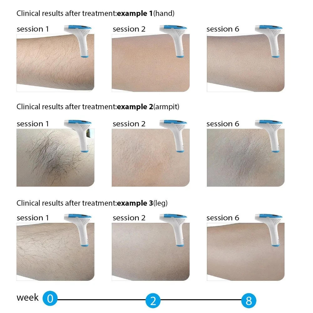 MLAY Depilator Laser Hair Removal Machine IPL Home Laser Pigmentation ...