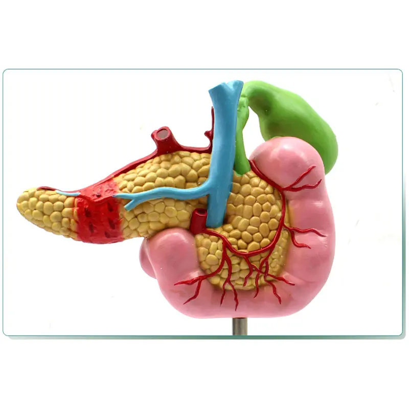 Medical Pancreatic Duodenal Gallbladder Pathological Model Gallstone ...