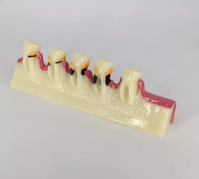 Resin-oral-periodontal-disease-classification-model-gingivitis-degree ...