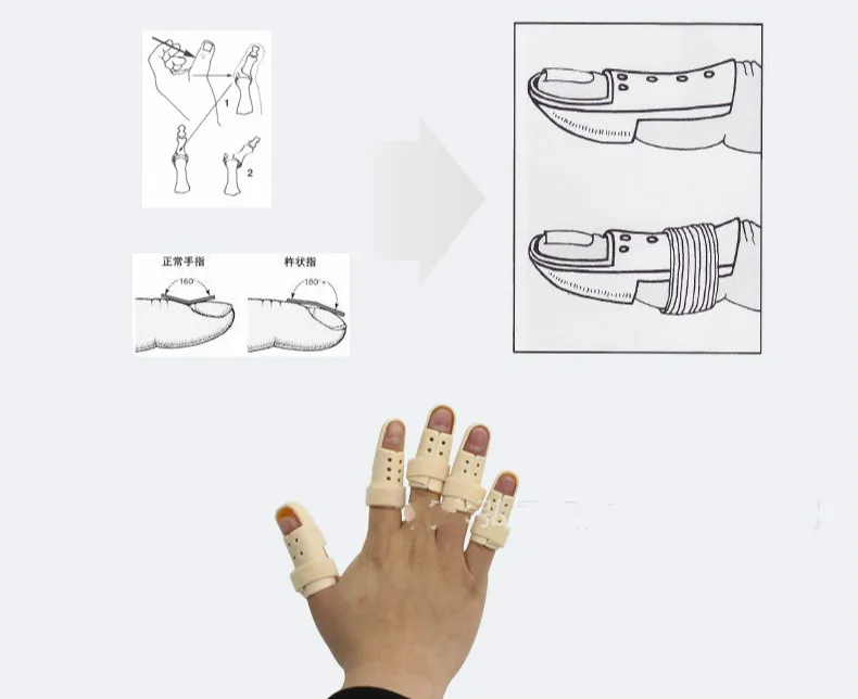 Hard Plastic Finger Splint Fracture Braces Tenosynovitis Ligament ...