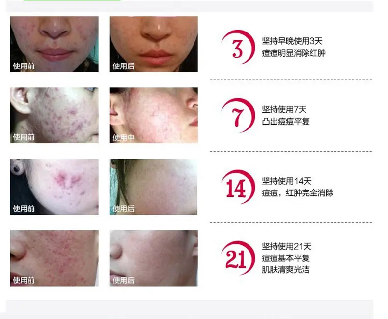 Acne Vulgaris Treatment Cream