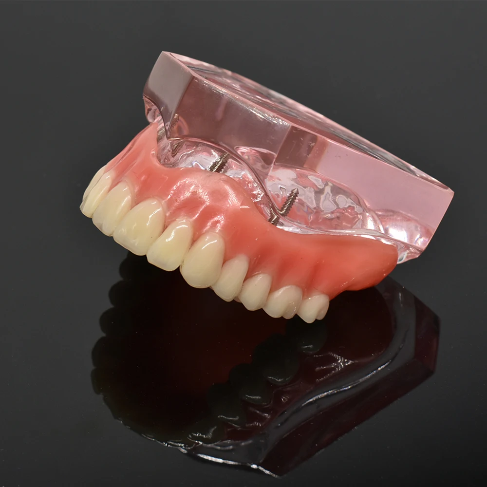 Modello-di-denti-overdenture-dentali-Modello-di-denti-inferiori ...