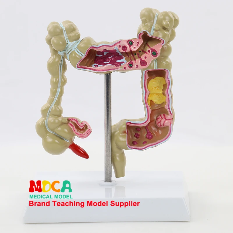 Human-Colorectal-Lesion-Model-Pathological-Anatomy-Colon-Diseases ...