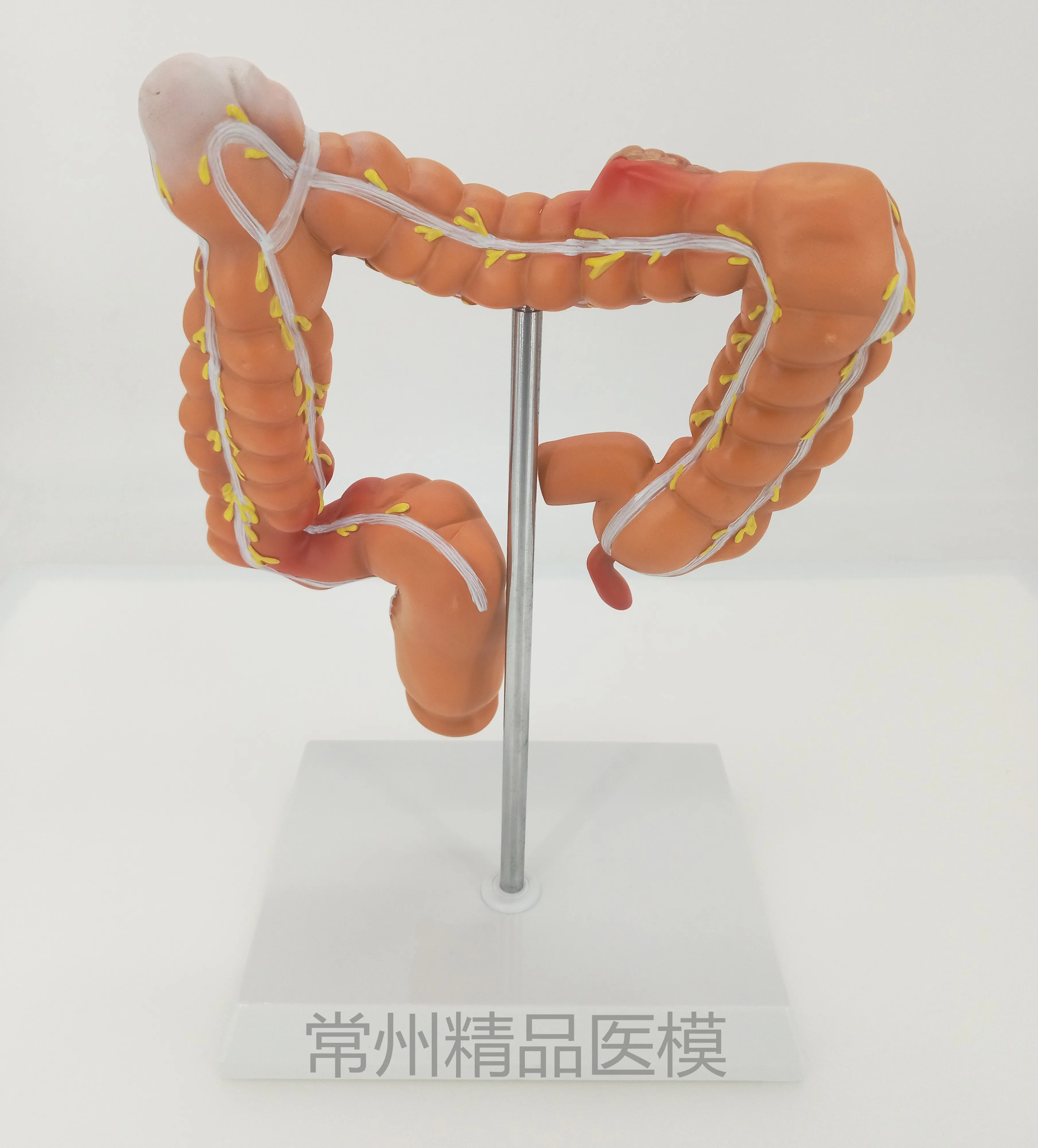 Colon pathological model Colorectal lesions specimens Intestinal ...