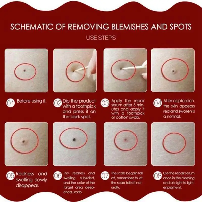 Mole & Skin Tag Removal Solution Painless Mole Skin Dark Spot Removal ...