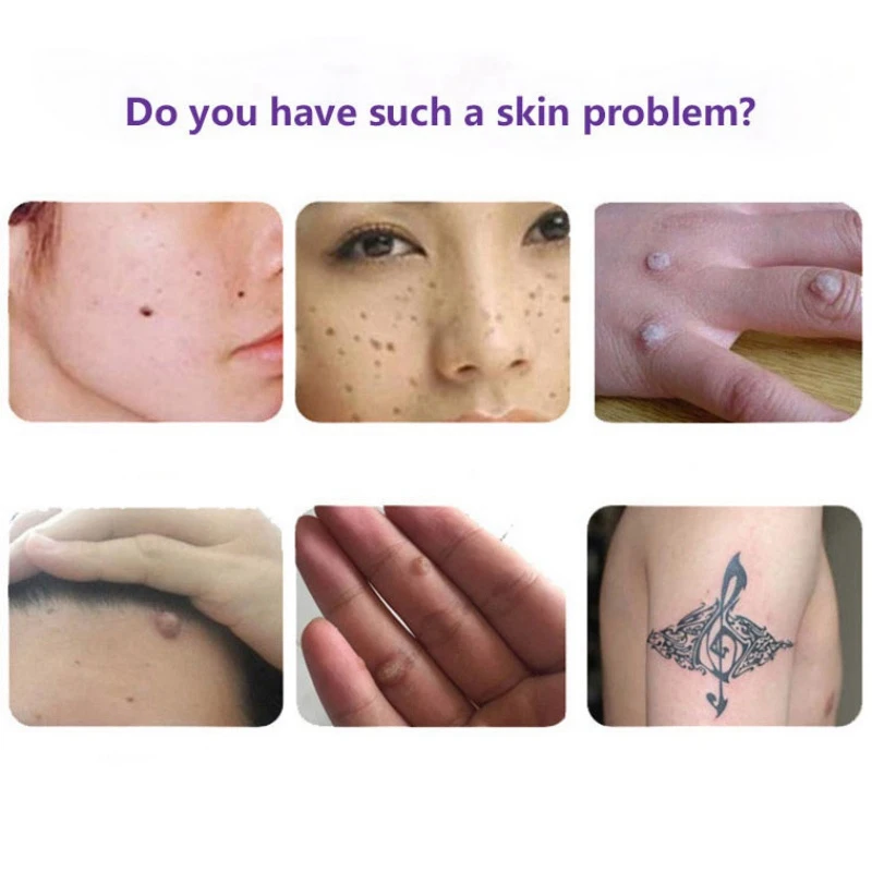 Mole Skin Removal Painless Mole Skin Dark Spot Face Wart Freckle Skin ...