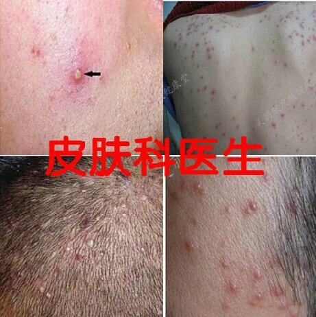 Futeling serpent graisse pommade pour cuir chevelu folliculite spéciale ...