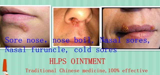 Sore In Nose