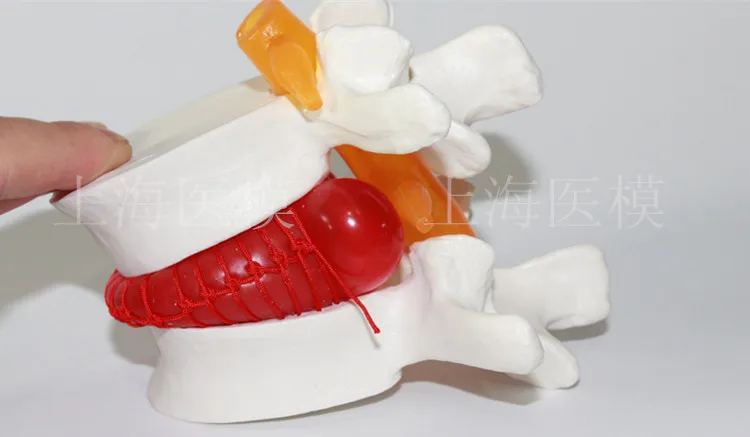 Human-lumbar-disc-herniation-model-demonstration-model-of-lumbar ...