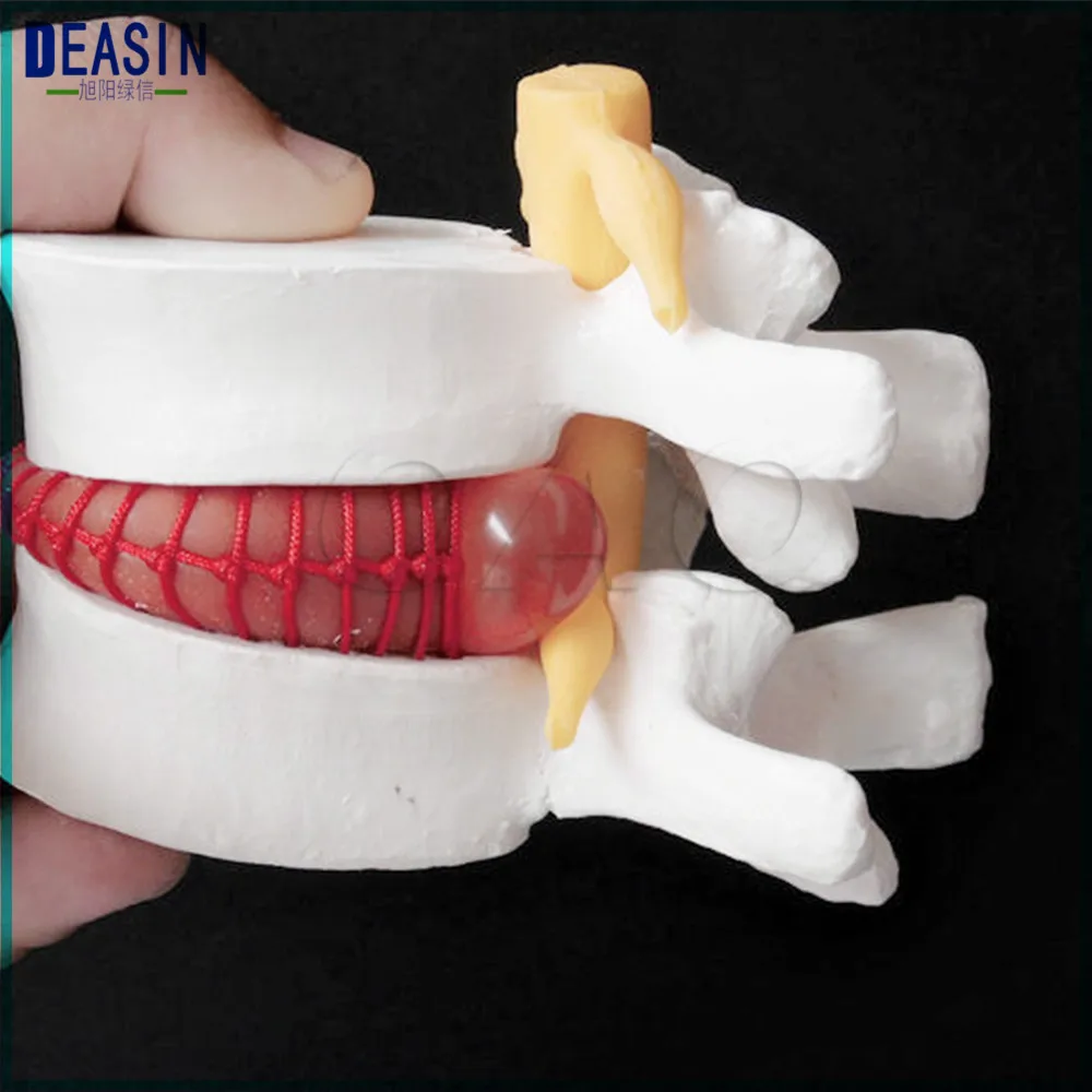 Human lumbar disc herniation model demonstration model of lumbar ...