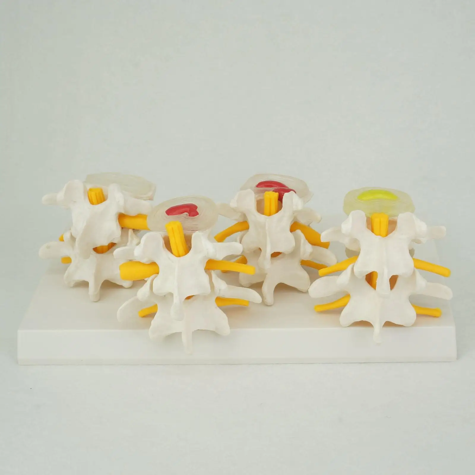 PVC-Anatomical-Human-Lumbar-Vertebrae-Degenerative-Disc-Disease-Model ...