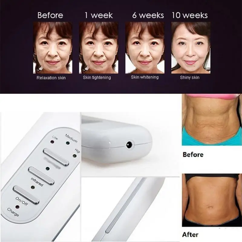 Radio Frequency Far-infrared Wave Therapy Skin Tightening Dot Matrix RF ...