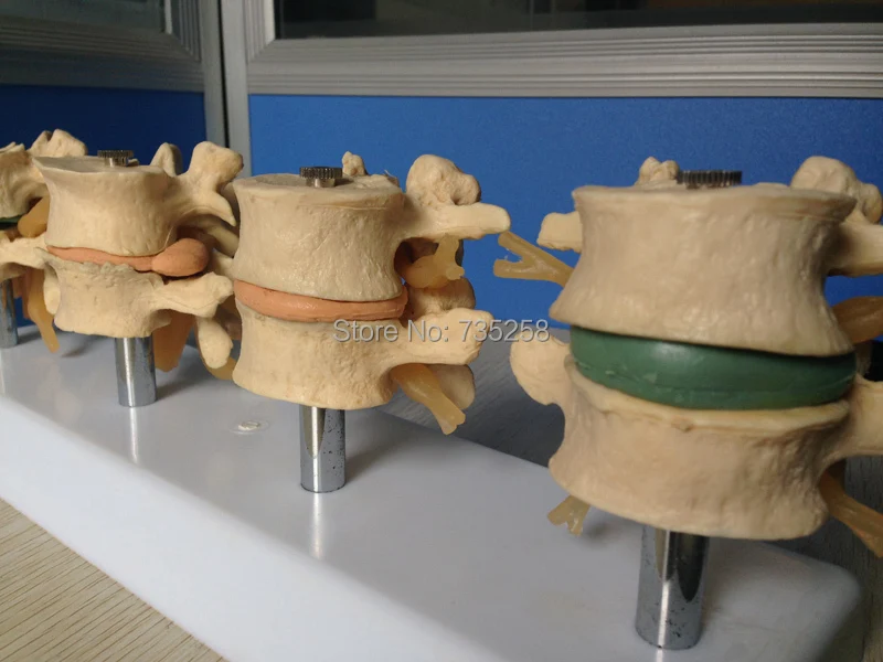Lumbar spine lesions presentation model ,Intervertebral disc model ...