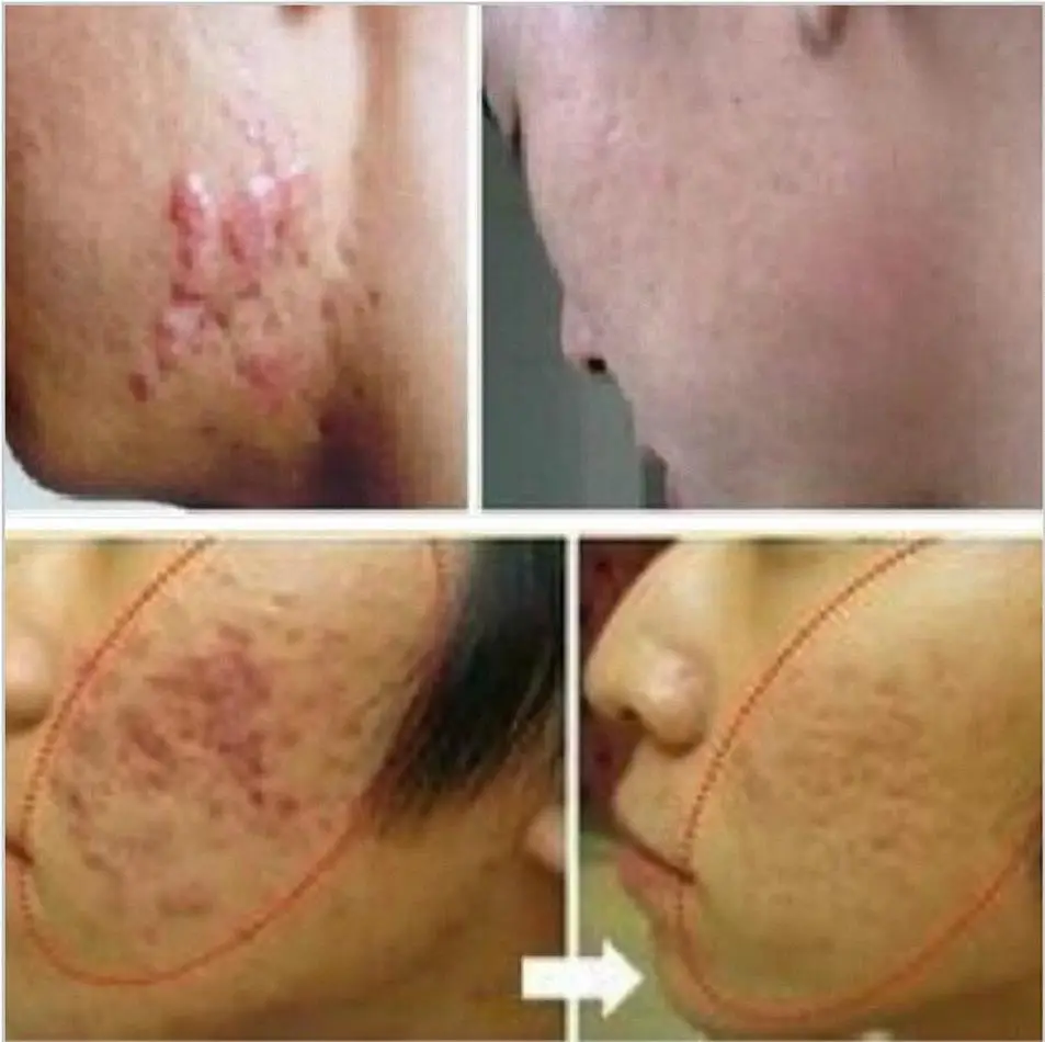 2015 The new Nuobisong Remove Scar Cream Remove Acne Spots Remove ...