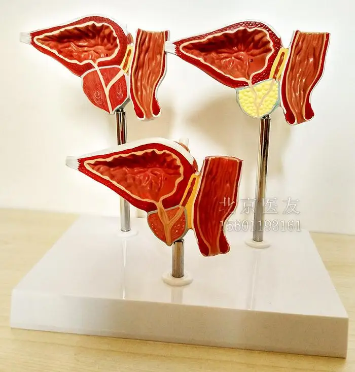 Prostate pathology teaching model Prostate lesions anatomy education ...