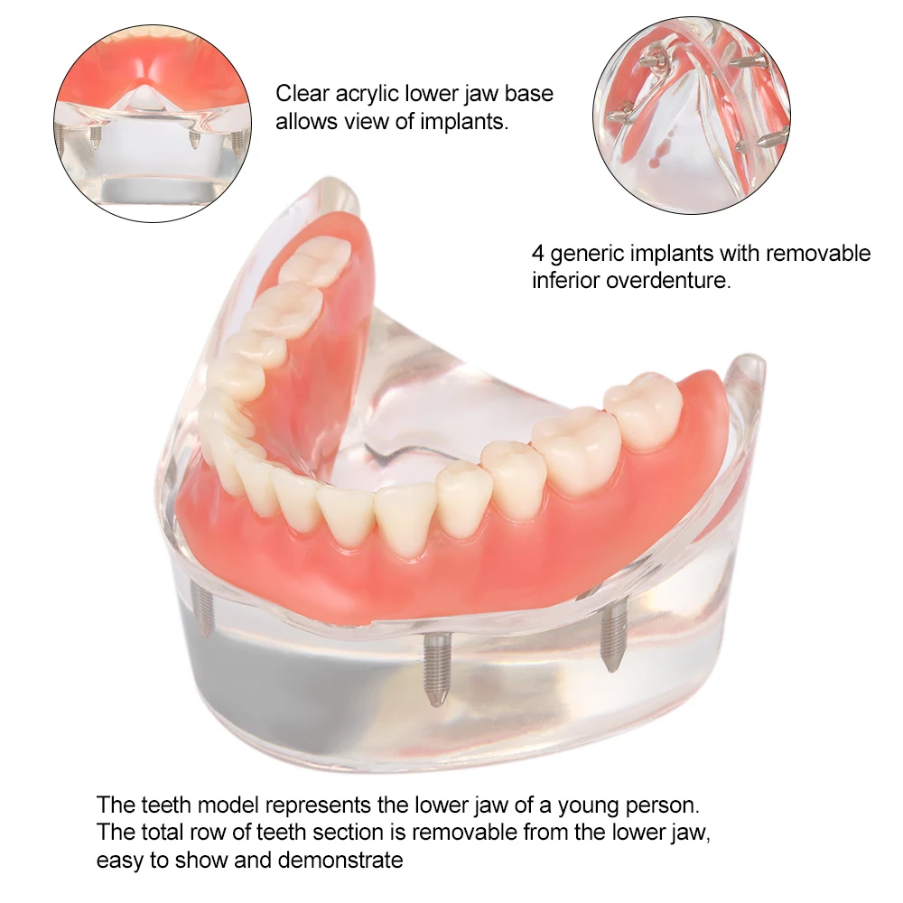 Купить Dental Teeth Study Model Dental Overdenture Interior Mandibular ...
