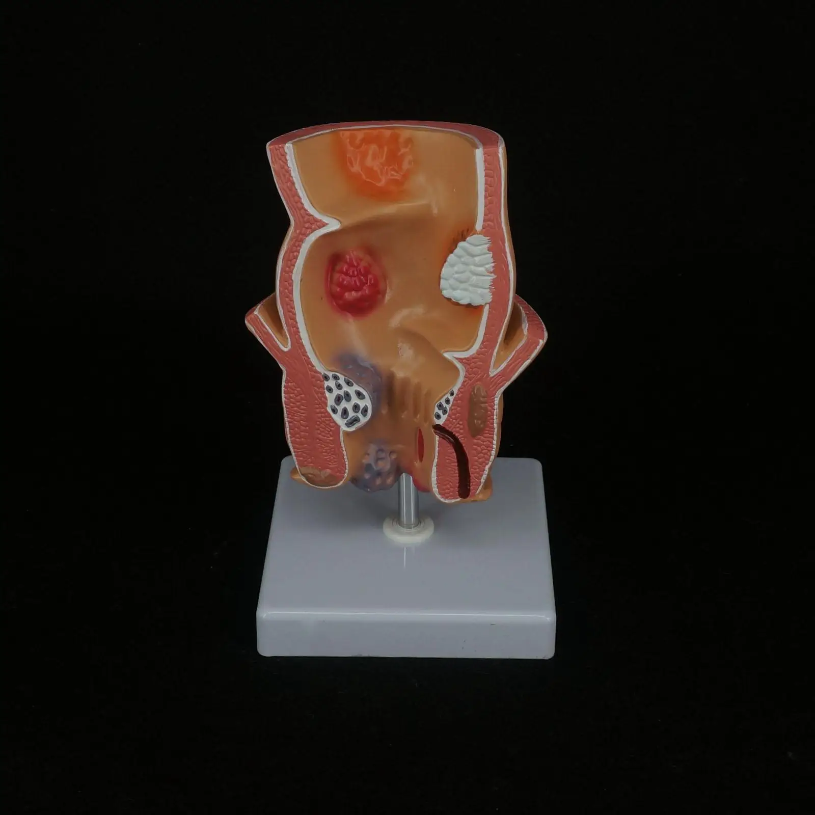 Anatomical-Human-Rectum-Pathology-Lesion-Model-Hemorrhoids-Anus-Medical ...