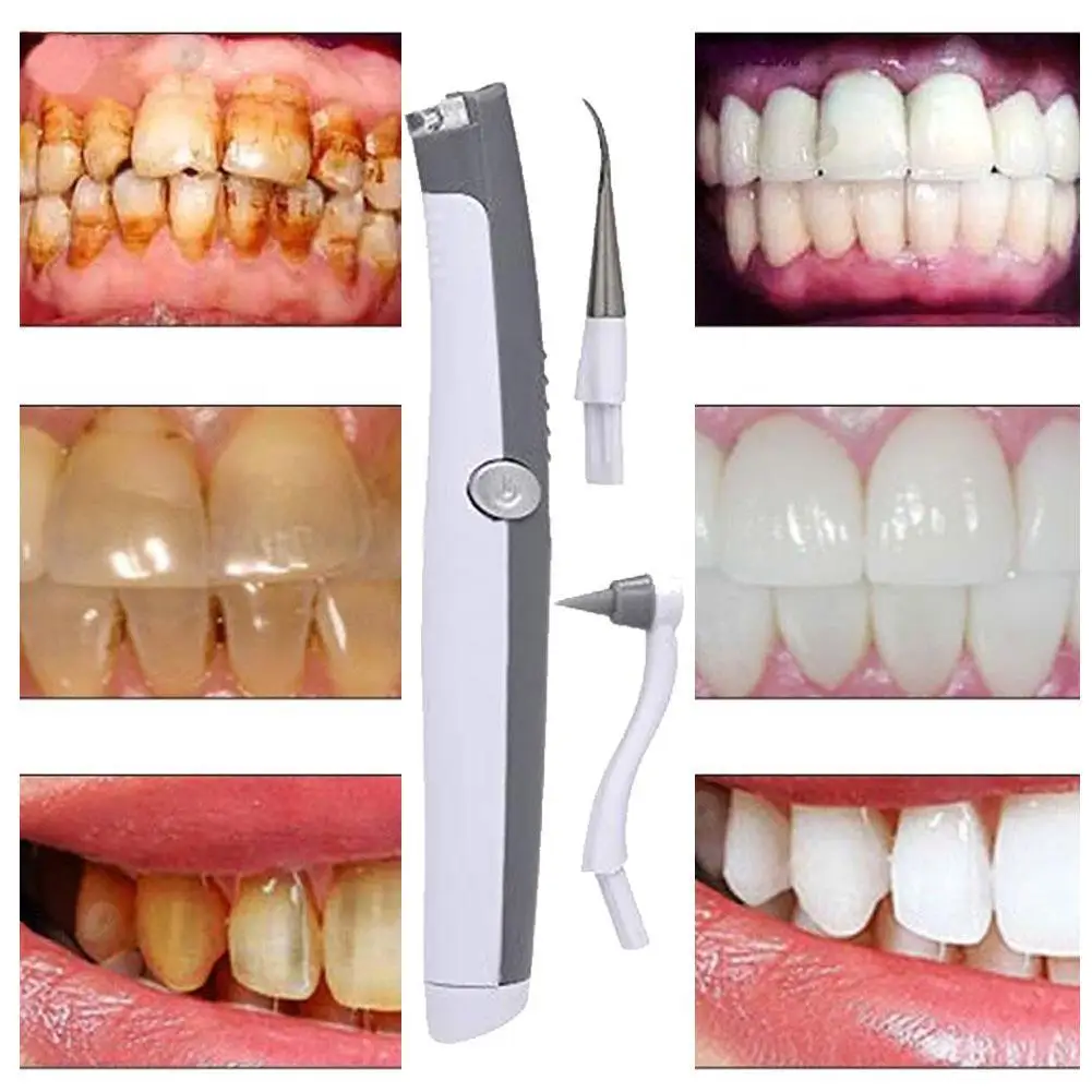 Electric Ultrasonic Tooth Stain Eraser - Not sold in stores