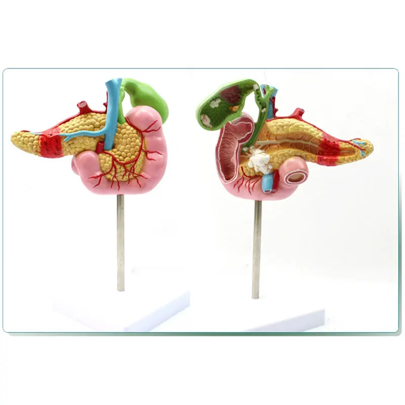 Medical Pancreatic Duodenal Gallbladder Pathological Model Gallstone ...