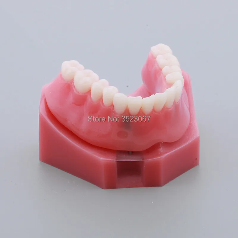 Human Dental lab denture teeth anatomy Overdenture Inferior with 2 ...
