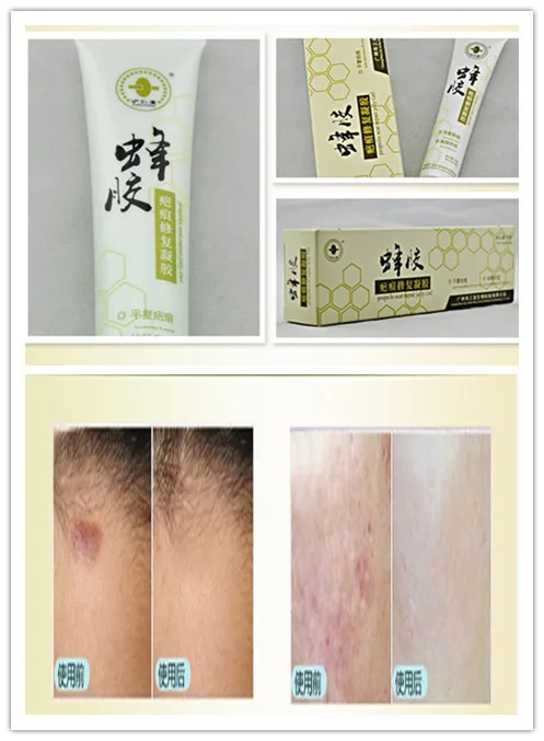 Hot-Sale-Top-Chinese-propolis-scar-repair-gel-remove-scar-cream-for ...