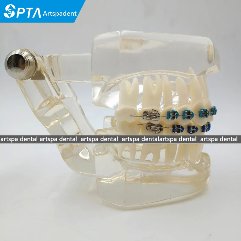 Dental Orthodontics Typodont Teeth Model Half Metal Half Ceramic Brace ... Dental Orthodontics Typodont Teeth Model Half Metal Half Ceramic Brace ...