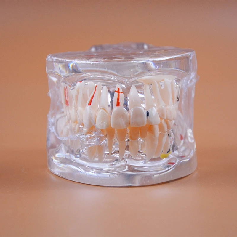 C4 Teeth Model High Quality Pathology Model With Implant For Hospital ...