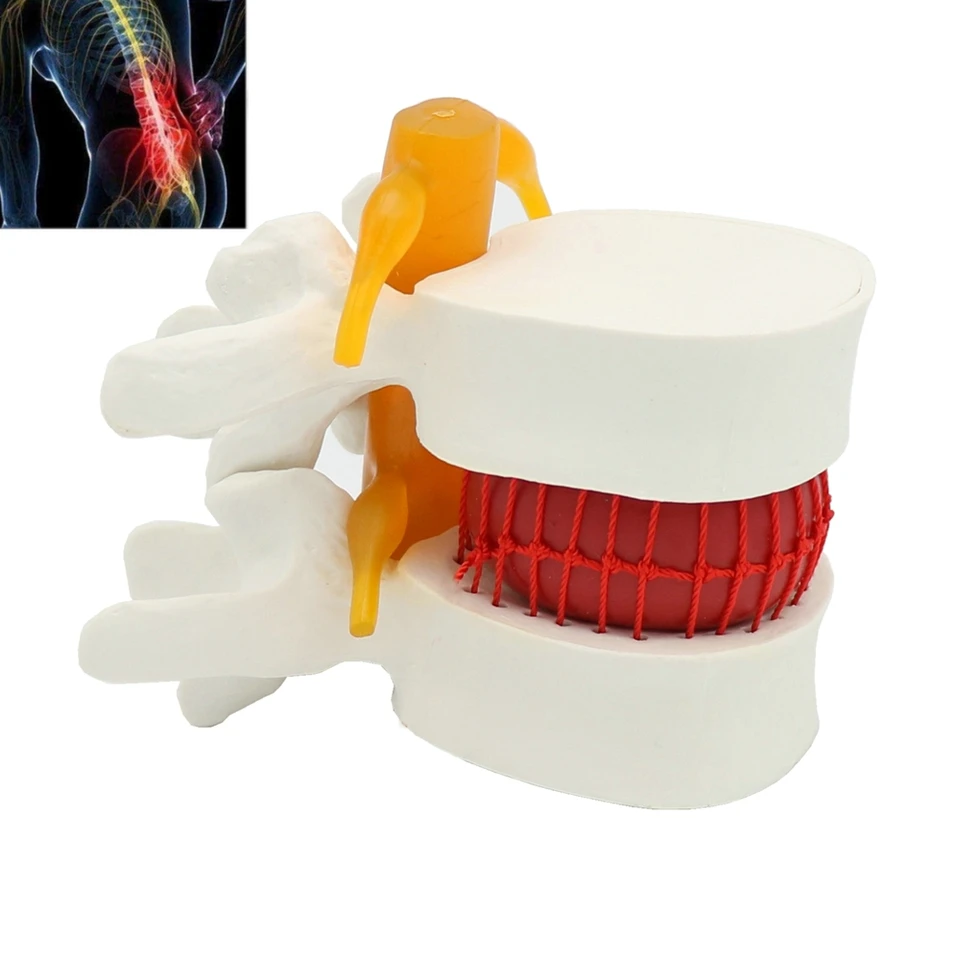 Axis Scientific Disc Herniation Model Iksvmsis Vertebral Column Model ...