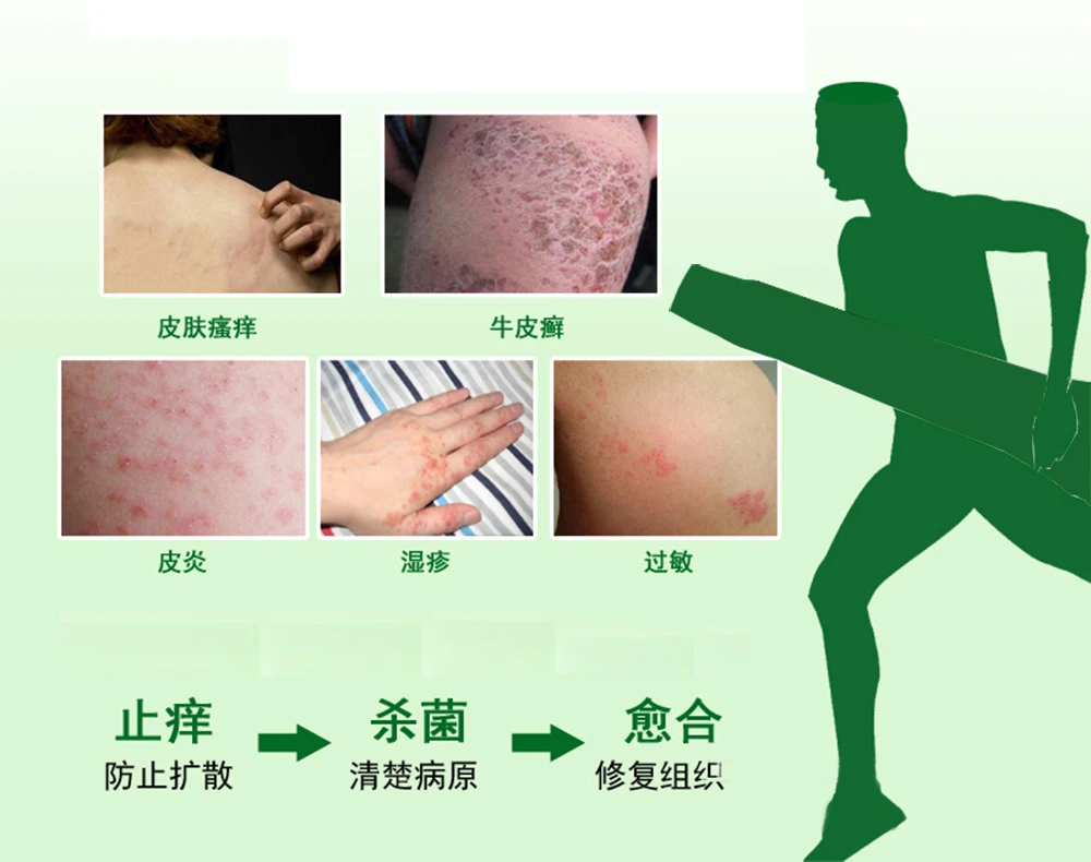 Купить ПСОРИАЗ ДЕРМАТИТ ЭКЗЕМА ЛЕЧЕНИЕ АНТИ-БАКТЕРИАЛЬНЫЕ ГРИБОК КОЖИ ...