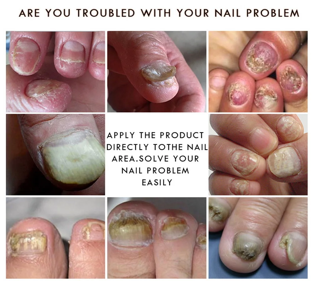 Действительно работает китайская медицина Штукатурка для лечения грибка ...