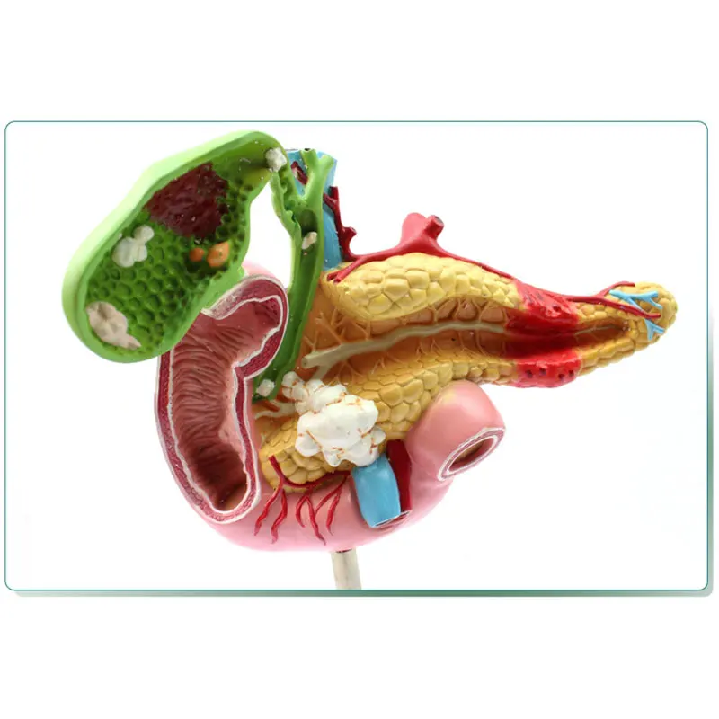 Medical Pancreatic Duodenal Gallbladder Pathological Model Gallstone ...