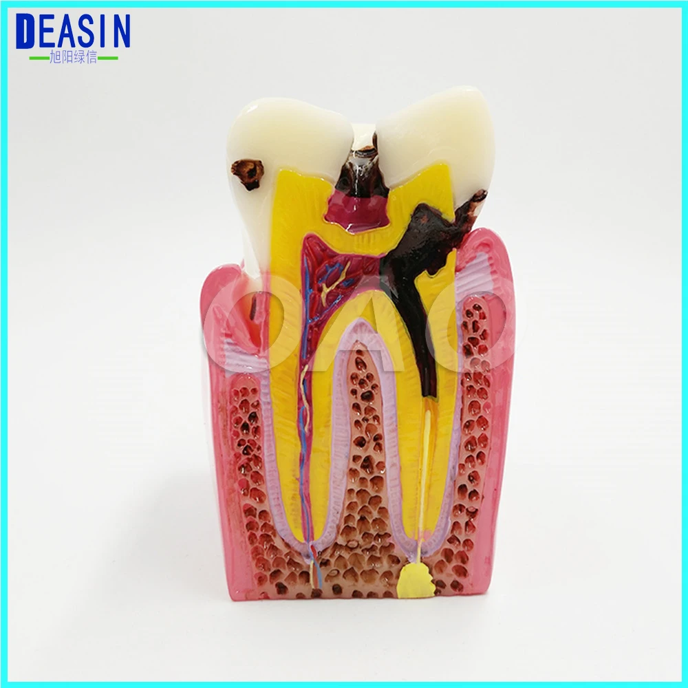 Denture-Teeth-model-6X-caries-comparison-model-tooth-decay-model ...
