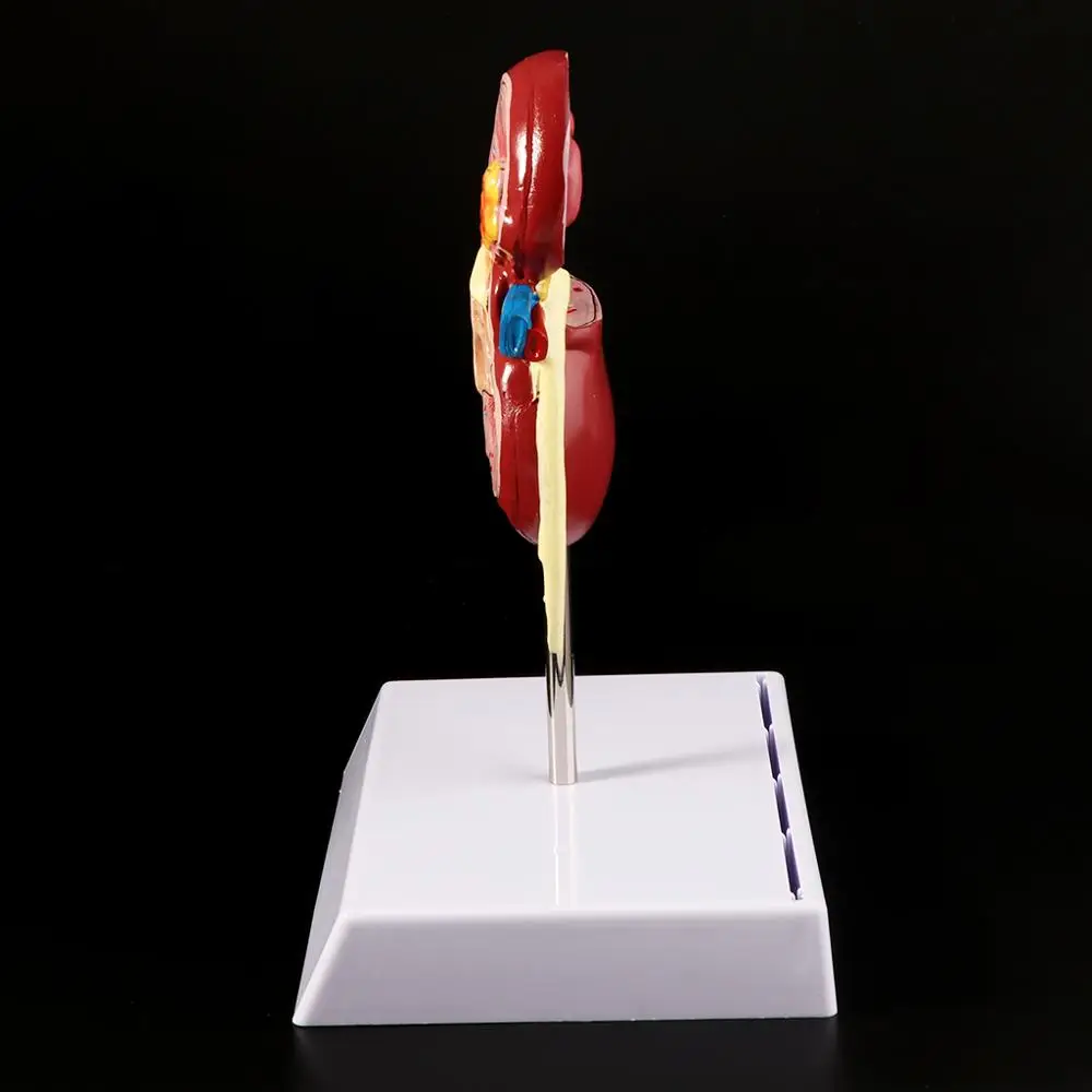 Life Size Kidney Diseased Model Anatomical Anatomy Diseased ...