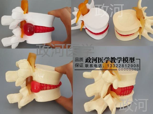 Human Lumbar Disc Protrusion Demonstration Model Lumbar Intervertebral ...