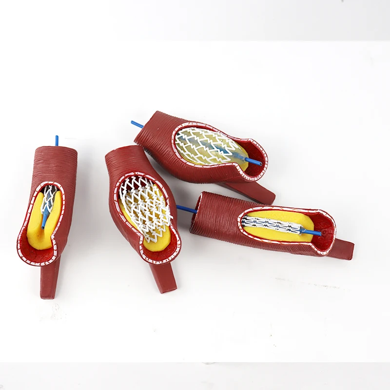 Blood Vessel Blocking Stent Enlargement Model Cardiac Stent Coronary ...